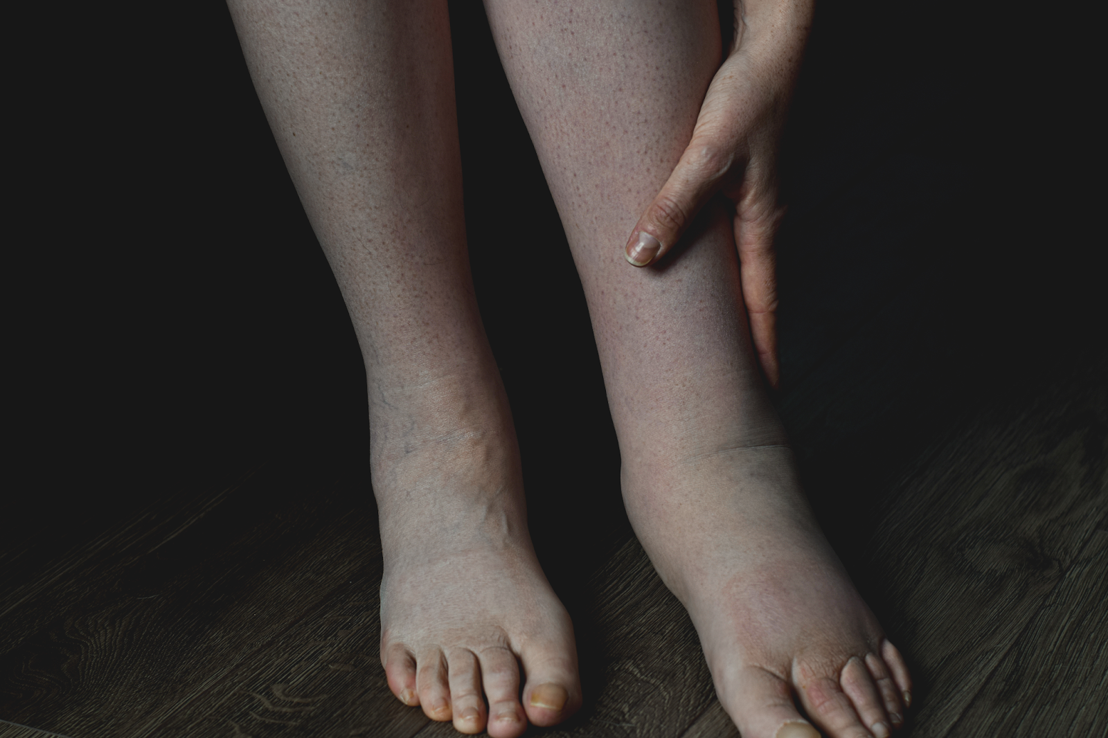 Federal Bill Increases Lymphatic Disease Research | Lipedema