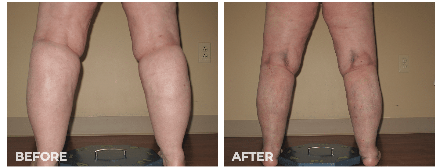 Benefits of Lipedema Lipo for Improved Knee Function | Lipedema.net