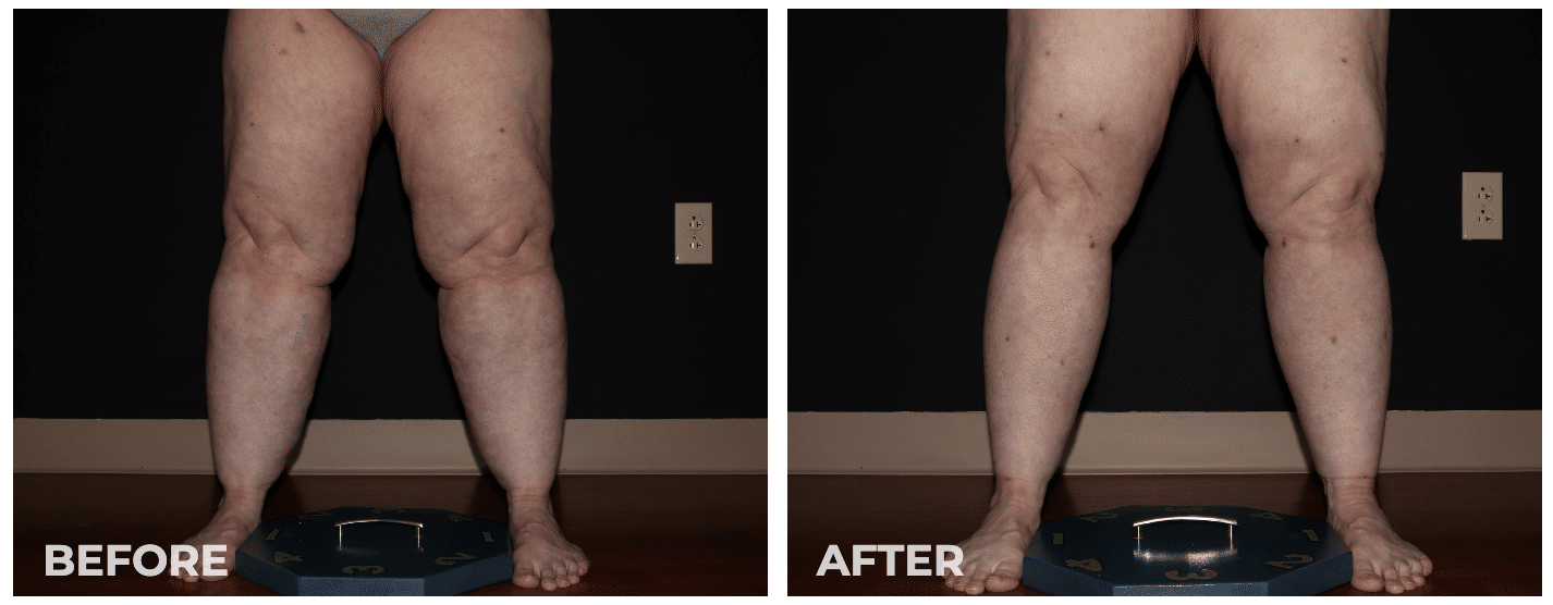 Benefits Of Lipedema Lipo For Improved Knee Function