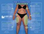 Celebrating Lipedema Awareness Month 2023 | Lipedema.net
