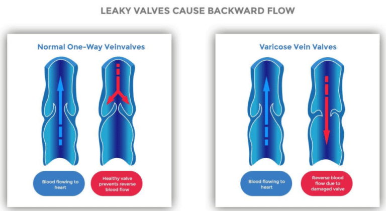 My Legs Are Fat and Out of Proportion, Do I Have Lipedema? - Lipedema ...