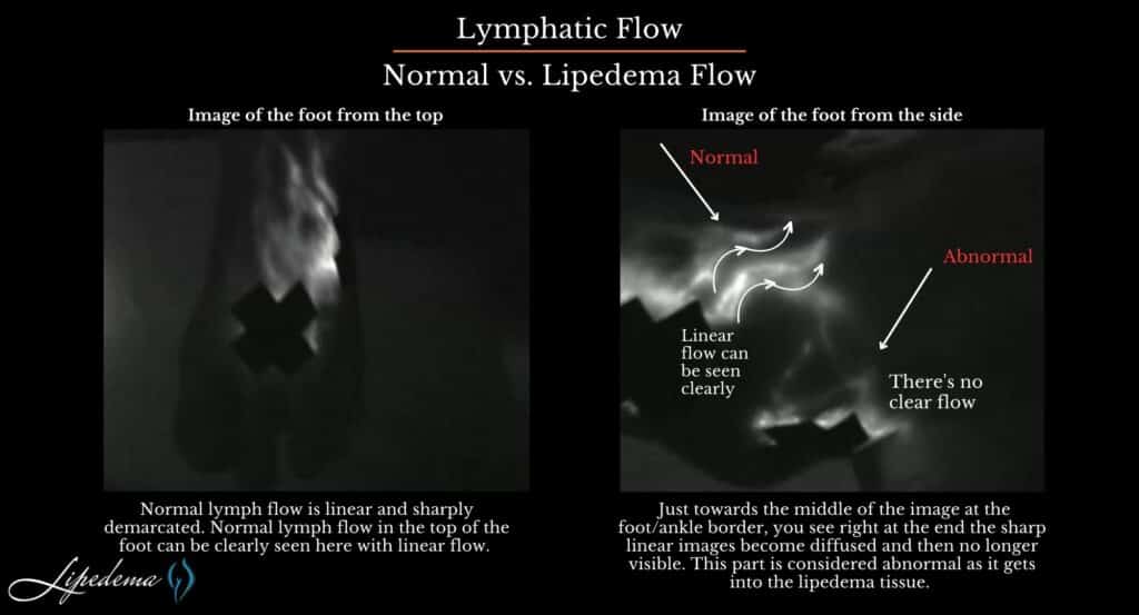 Lymphatic Flow in Lipedema - Lipedema Medical Solutions