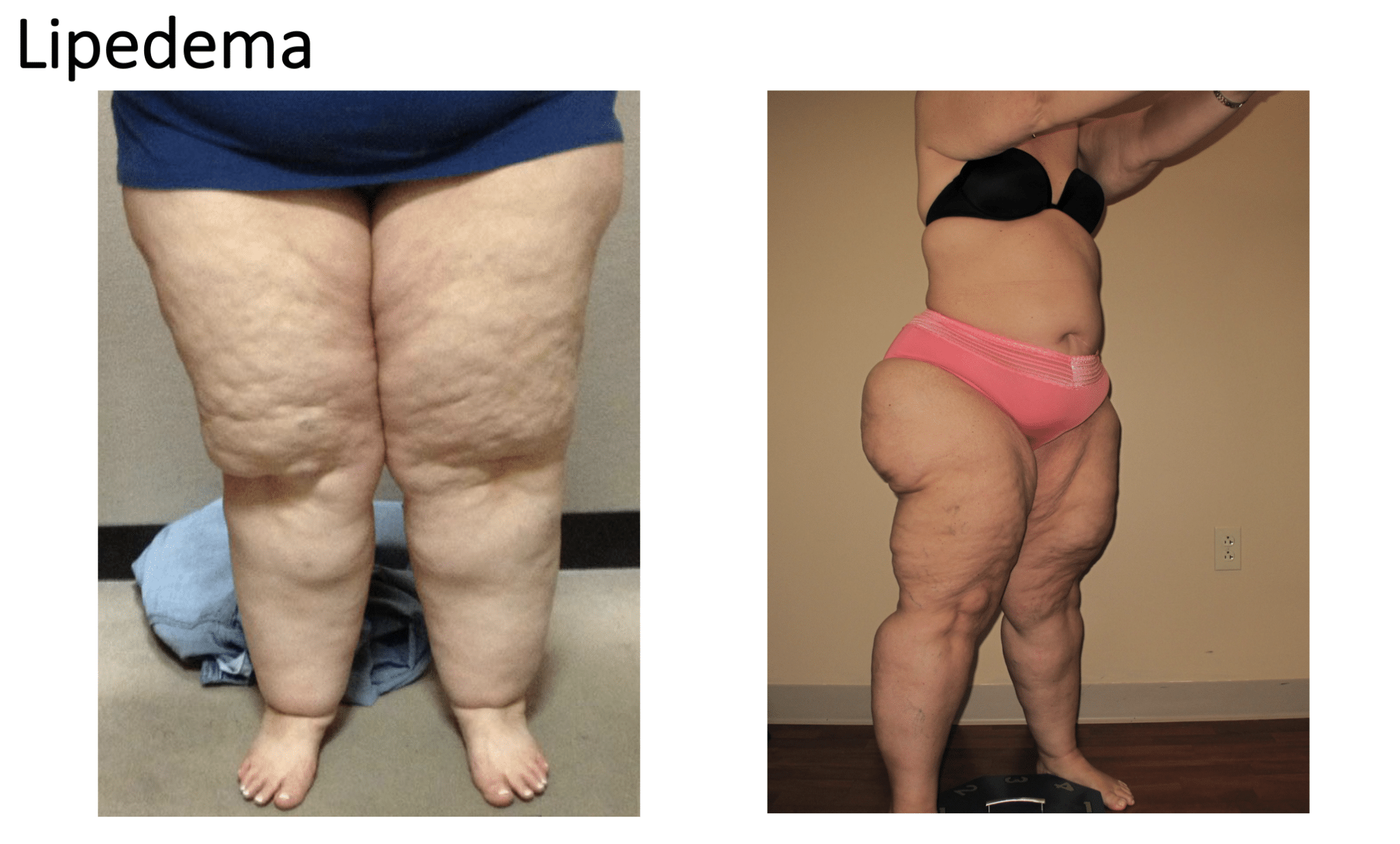 » Lymphedema vs. Lipedema - Lipedema