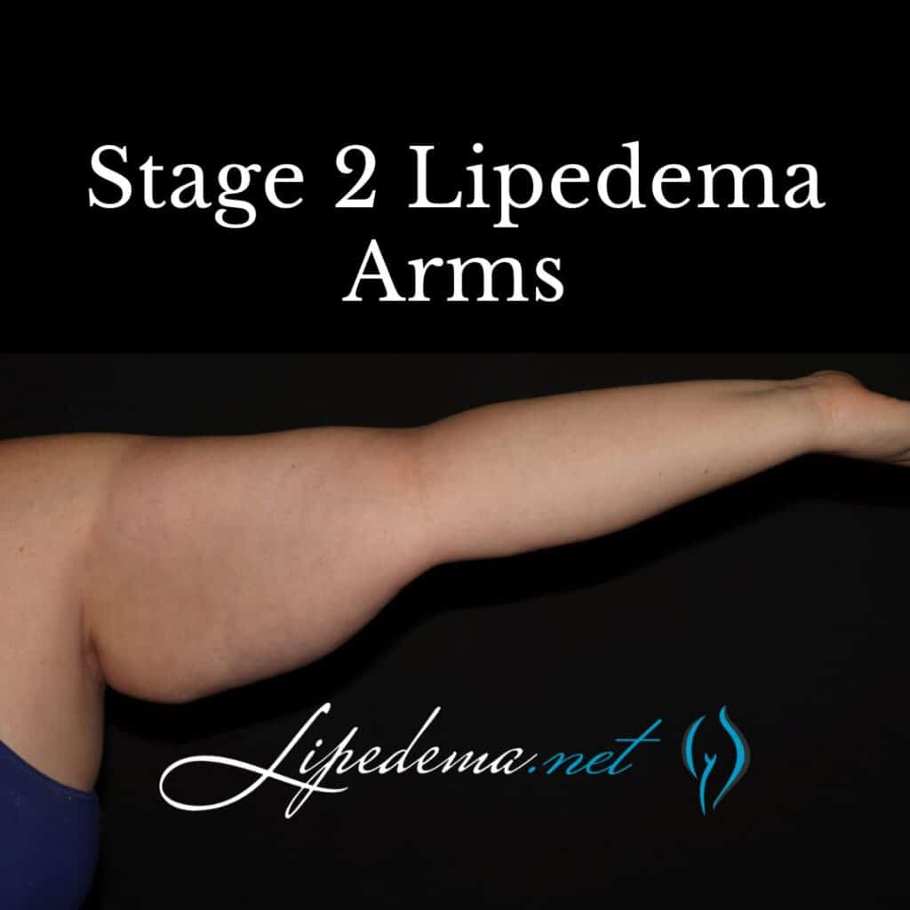» Lipedema Stages & Types - Lipedema