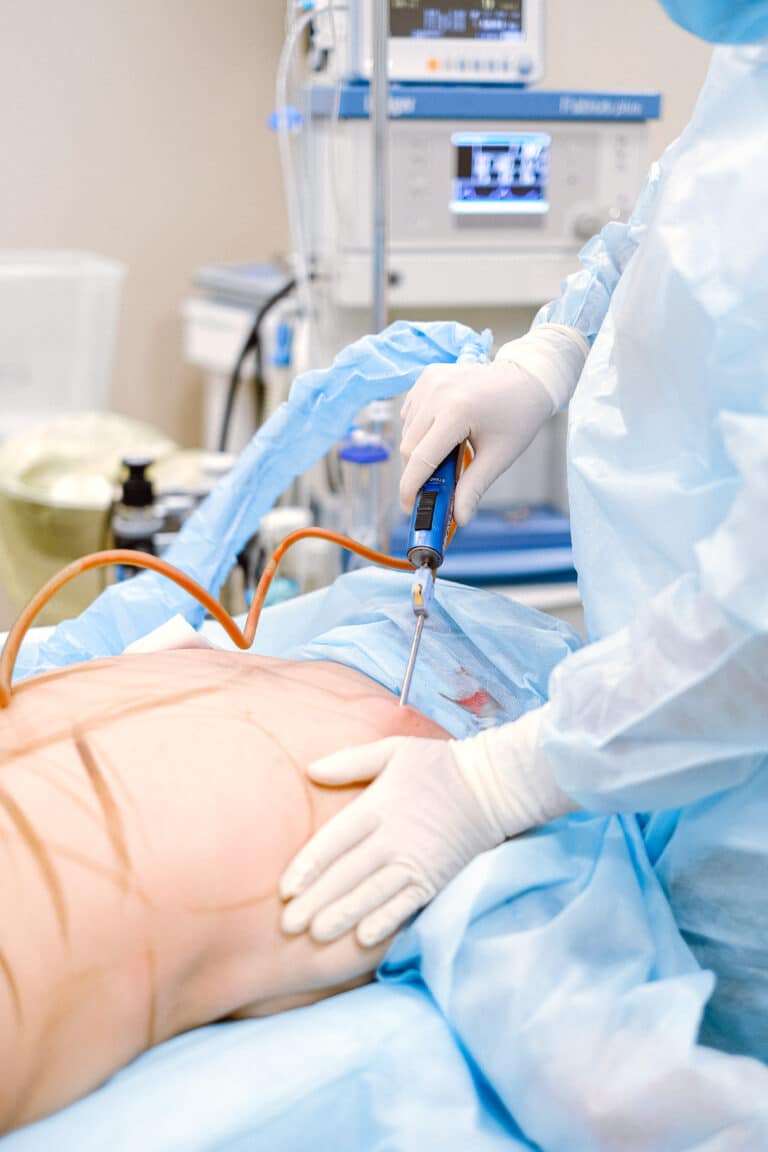 » Basic Overview of Liposuction for Lipedema - Lipedema