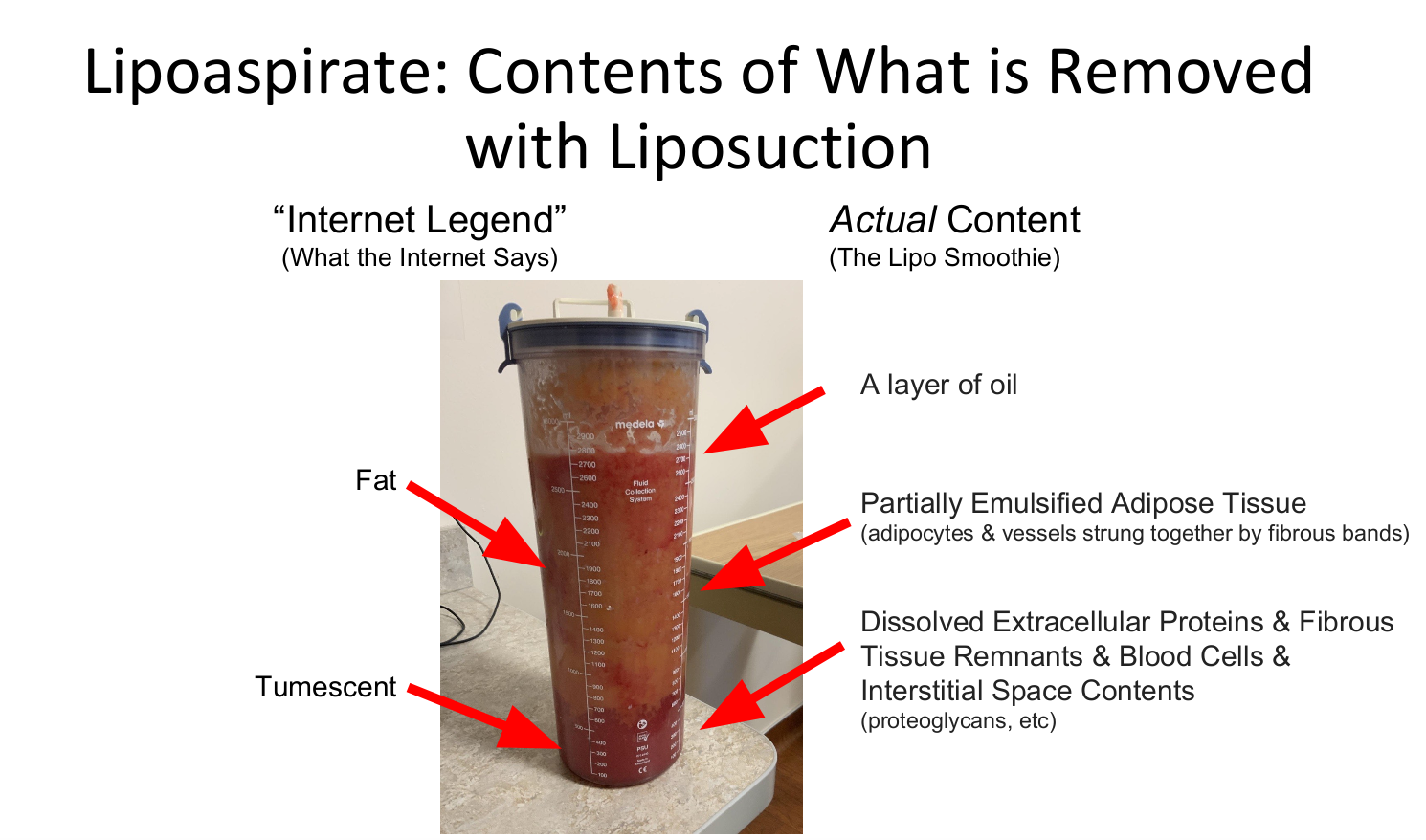 Understanding Lipoaspirate in Lipedema Surgery: Why Volume Doesn't Tell ...