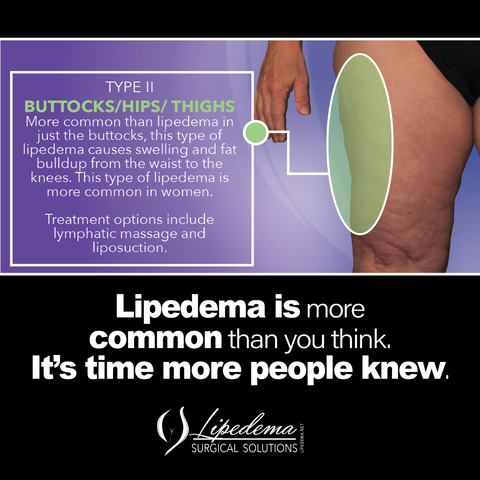Understanding the Types and Stages of Lipedema - Lipedema Medical Solutions